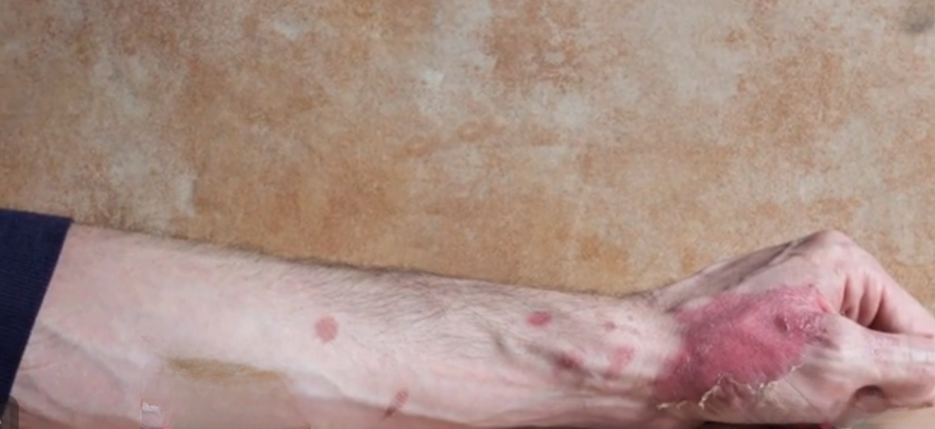 Reducing Pain and Scarring: The Surprising Role of Hypnosis in Burn ...